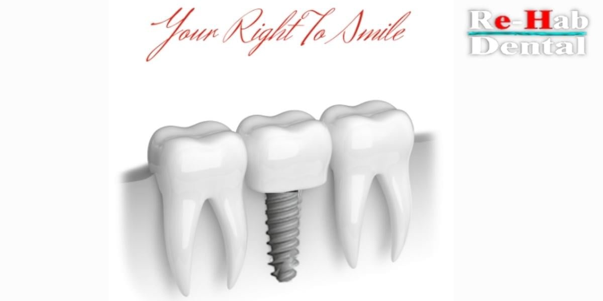 Dental Implant Design And Its Relationship To Long-Term